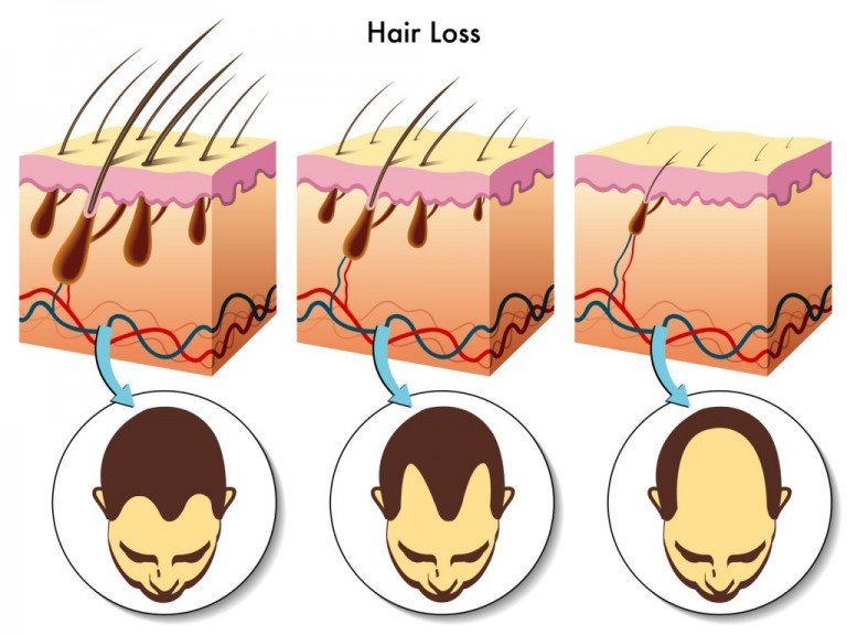 Why Do We Lose Hair From Our Head, But Not The Rest Of Our Body ...
