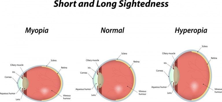 What Is Bad Vision? Does Not Wearing Glasses Worsen Your Vision?