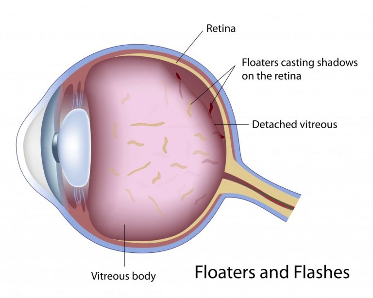 What Are Those Floating Things In Your Eyes? » ScienceABC