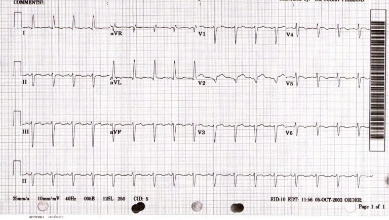 What Is A Defibrillator? How Does Defibrillation Work To Revive Patients?
