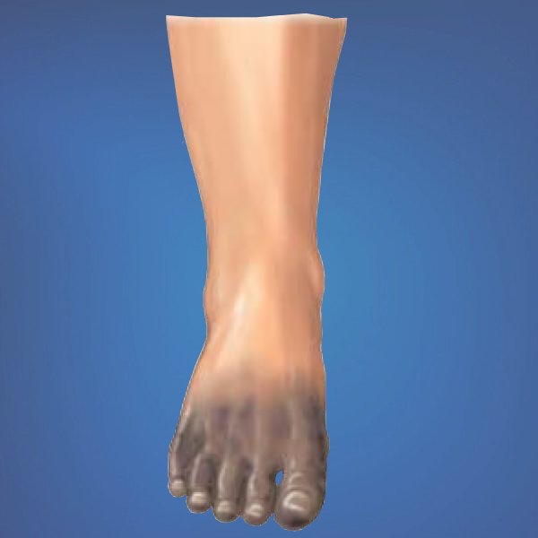 What Is Necrosis? What Are The Types Of Necrosis?