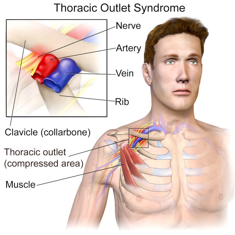 What Are Cervical Ribs? Are They Dangerous?