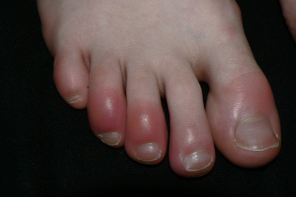Acrocyanosis: Definition, Causes And Treatment