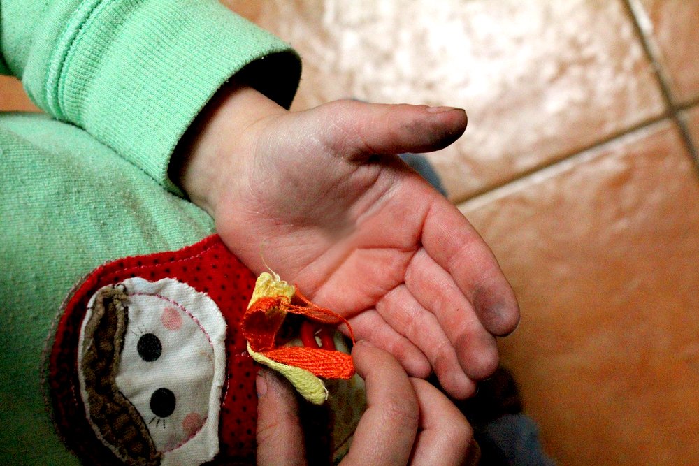 Peripheral Cyanosis In The Nail Beds