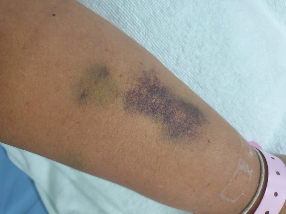 What Did The Batman Mean When He Said “Ecchymosis”? » ScienceABC